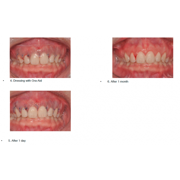 Ora-Aid Intra oral dressing