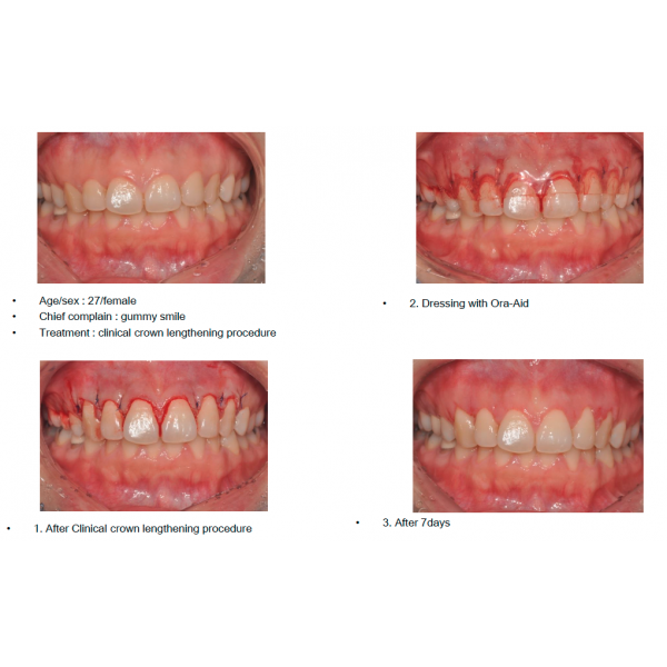 Ora-Aid Intra oral dressing